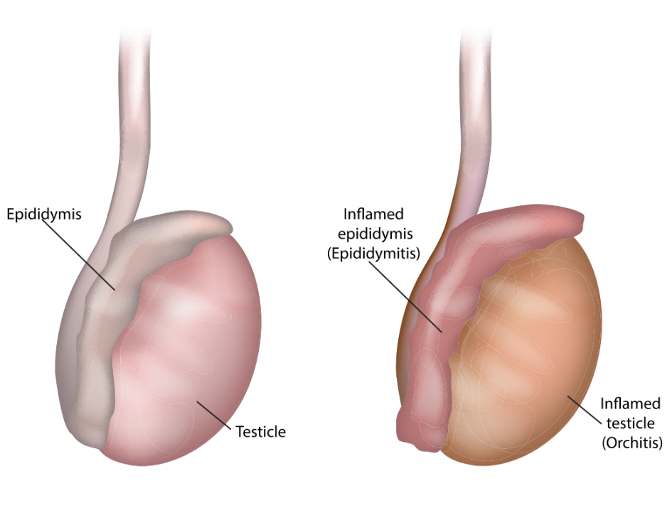 Scrotal Abscess Scrotal Abscess